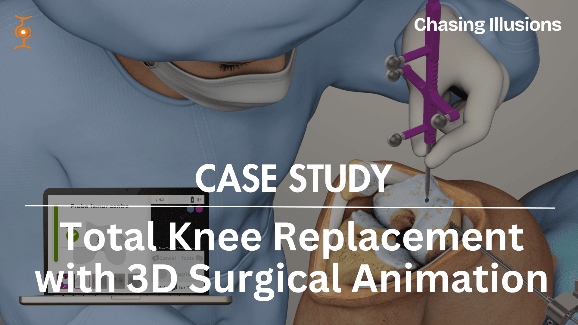 Total Knee Replacement Case Study with 3D Surgical Animation
